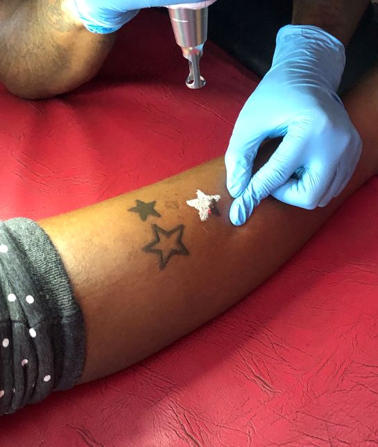 Factors that Influence Laser Tattoo Removal - Rebel Inks Tattoos ...