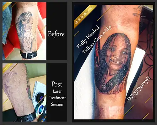 Picosecond Laser Tattoo Removal in Nairobi, Kenya - Rebel Inks Tattoos ...