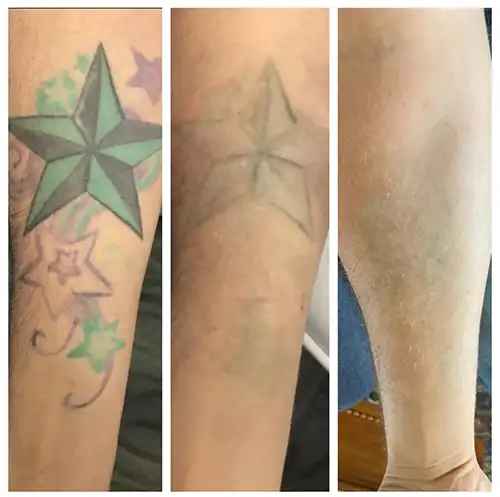 Ruby Laser Tattoo Removal in Nairobi, Kenya - Rebel Inks Tattoos ...