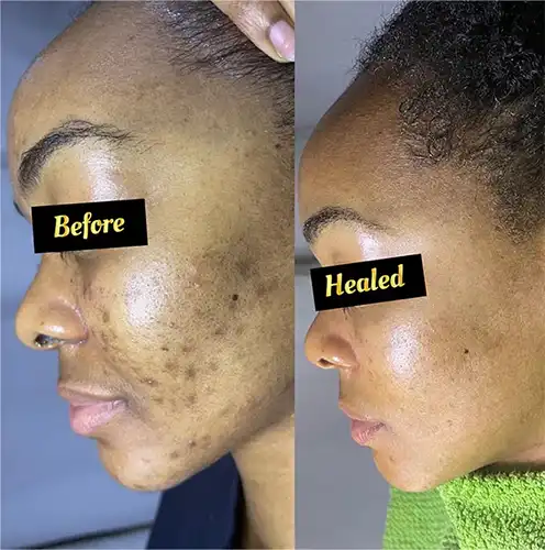 Black/ Dark Spots Removal in Nairobi, Kenya - Rebel Inks Tattoos ...